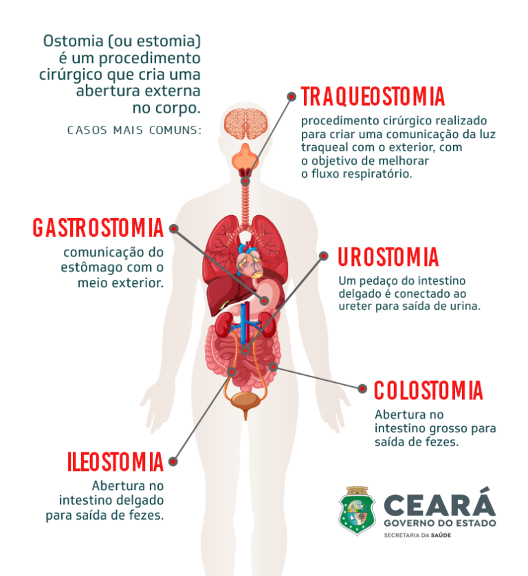 Programa da Rede Sesa proporciona maior qualidade de vida a pessoas ostomizadas - Secretaria da ...