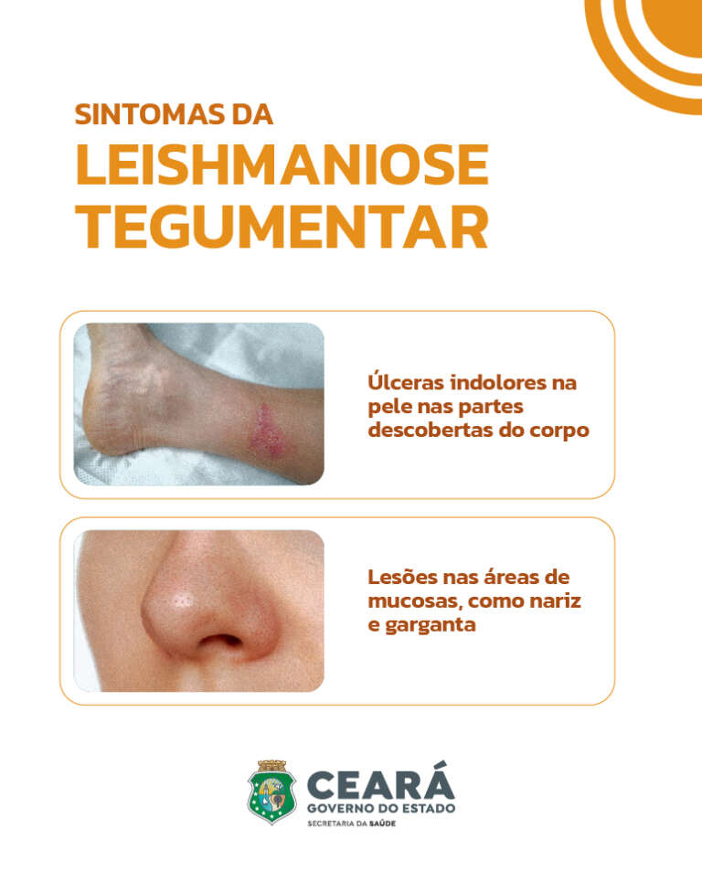 Leishmaniose tegumentar: saiba o que é e como prevenir a doença